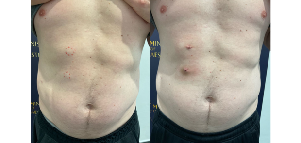 Lipoma Removal Treatment | Fat Lumps Surgery Procedure in UK